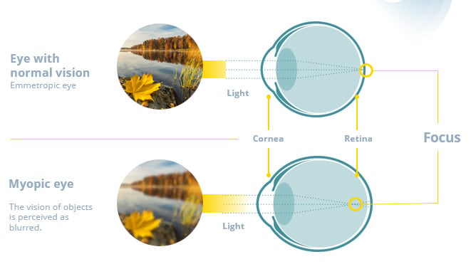 EXTREME PRESCRIPTIONS, THE VISUAL SOLUTION FOR EXTREME MYOPIA ...