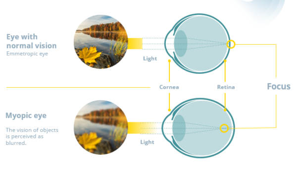 EXTREME PRESCRIPTIONS, THE VISUAL SOLUTION FOR EXTREME MYOPIA ...